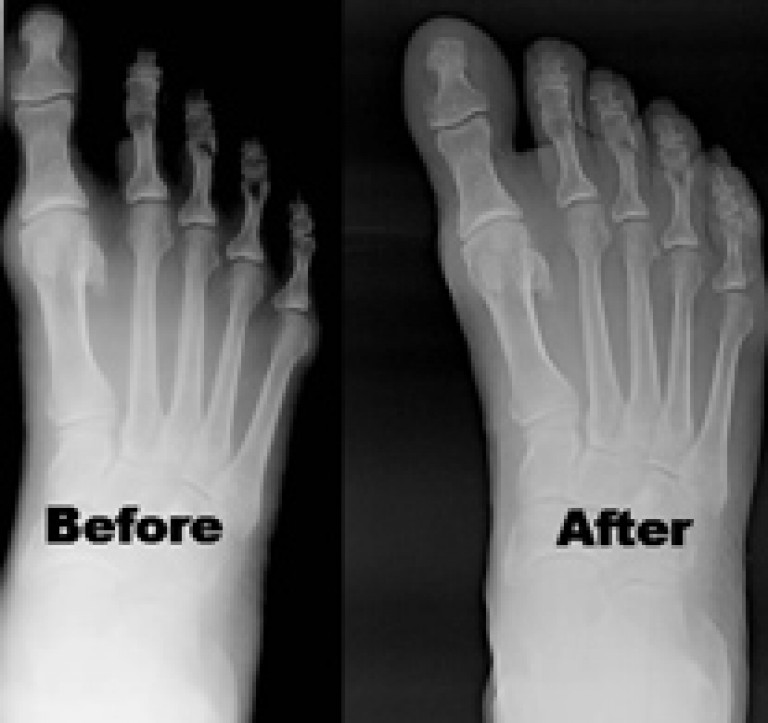You Shouldnt Always Feel Like You Are Walking On Pebbles Fat Pad Restoration At The Foot
