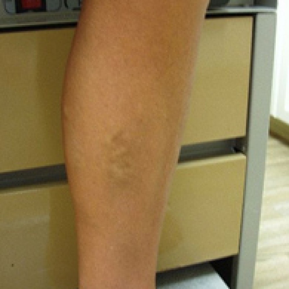 How Are Varicose Veins Diagnosed and Treated?