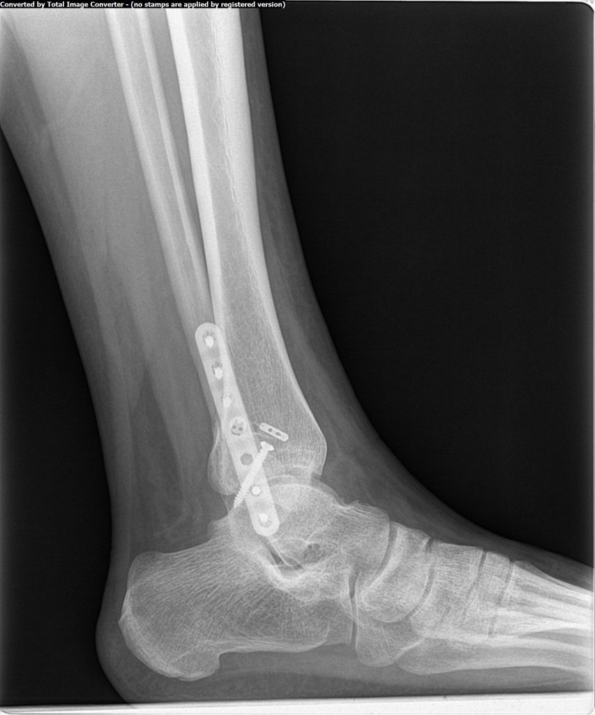 Ankle Fracture Treatment Boynton Beach | Foot, Ankle & Leg Vein Center ...