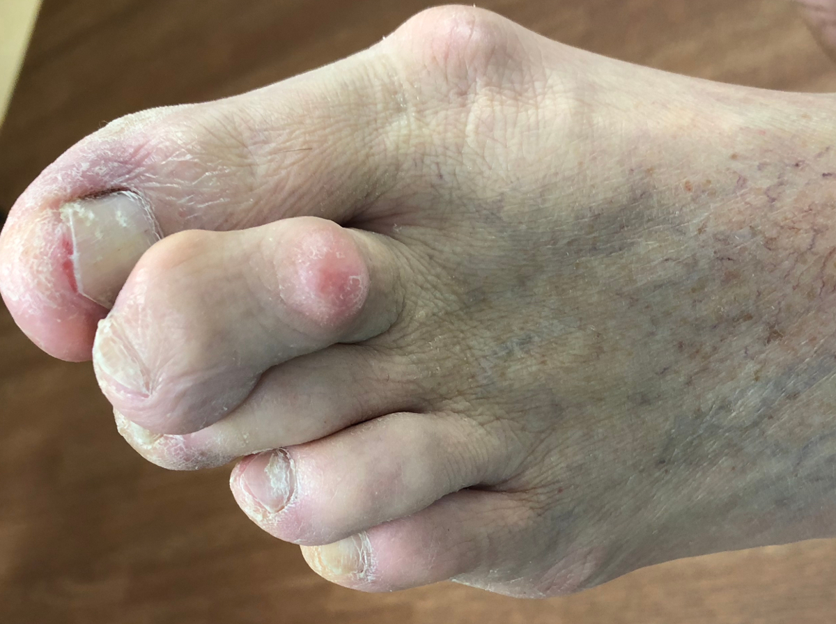 Bunion Treatment: Conservative Care and Surgical Correction