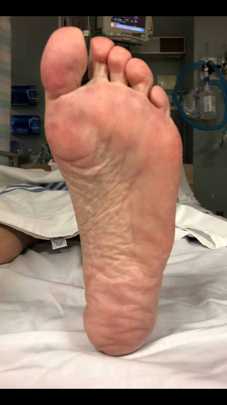 Fat Pad Cushioning Boca Raton What Causes Fat Pad Atrophy