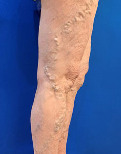 Ambulatory Phlebectomy - Stop Living with Bulging, Unsightly Leg Veins