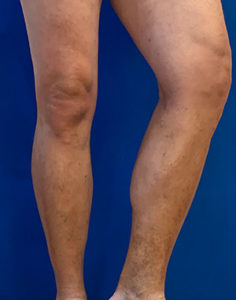 Ambulatory Phlebectomy - Stop Living with Bulging, Unsightly Leg Veins