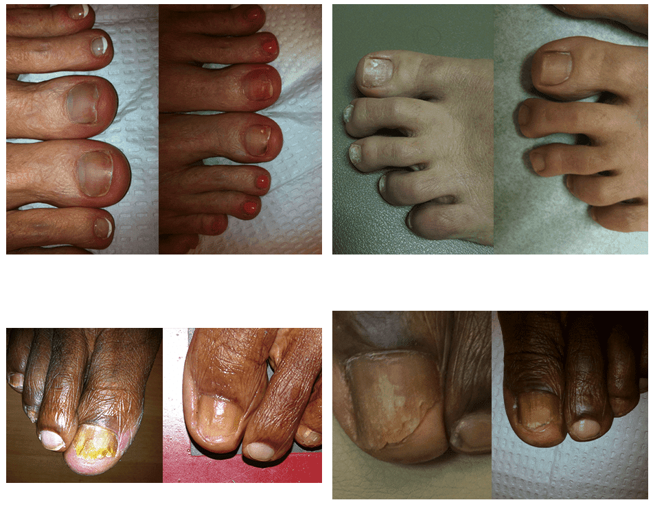 Medicure - Treatment for Dry & Damaged Foot Skin