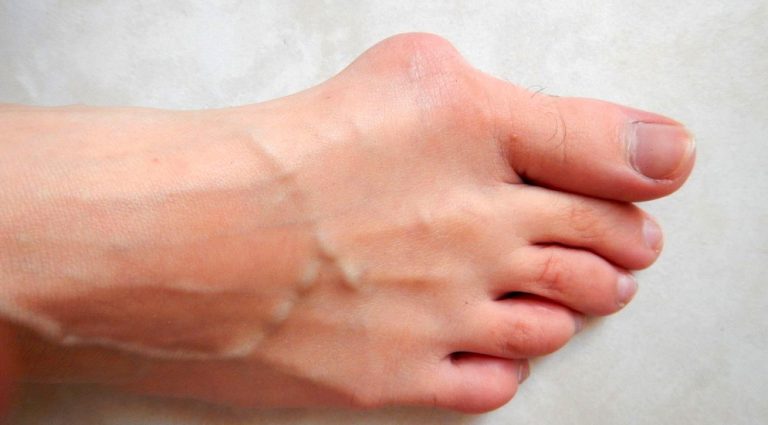 Bunion Treatment: Conservative Care and Surgical Correction