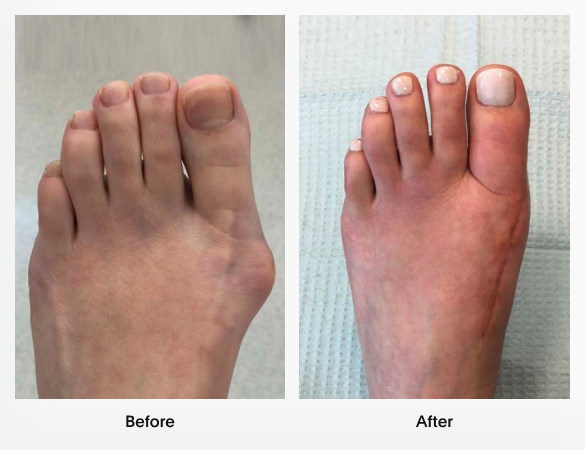 Bunion Treatment: Conservative Care and Surgical Correction