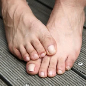 Accessory Navicular or Kidner Foot | South Florida Podiatrists