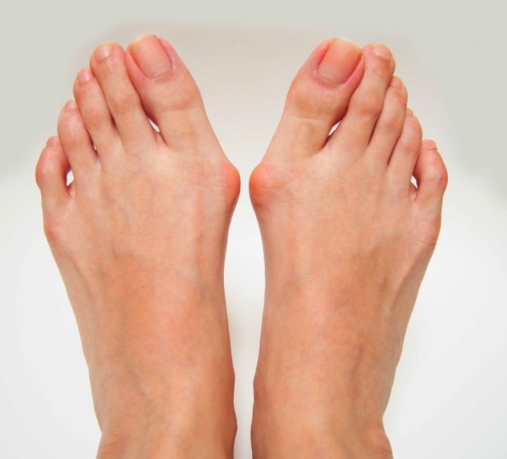 Foot Care Treatments for Neuromas by Foot Doctors